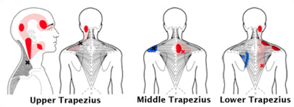 Wat zijn Triggerpoints en hoe kunnen ze behandelen? - Cardo Healthcare